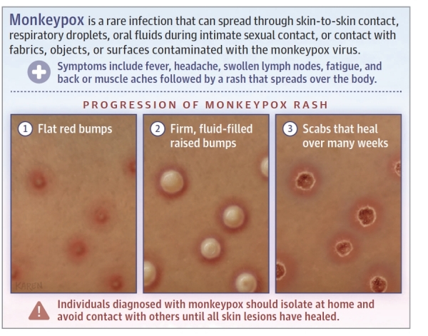 What is Monkeypox? | Old Dominion University