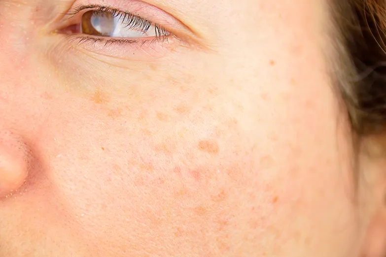 Are dark skin spots cause for concern | Old Dominion University